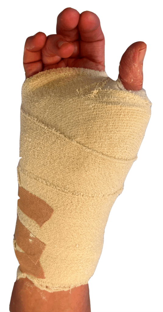 Having a Trapeziectomy – Fife Virtual Hand Clinic