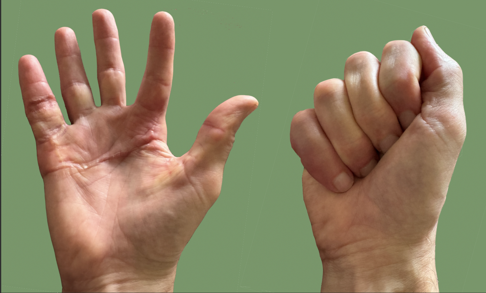 Having a Dermofasciectomy – Fife Virtual Hand Clinic
